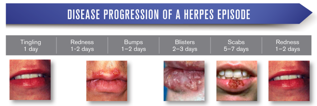 Stages of a Cold Sore Breakout | Sitavig (acyclovir), 50mg Muco ...