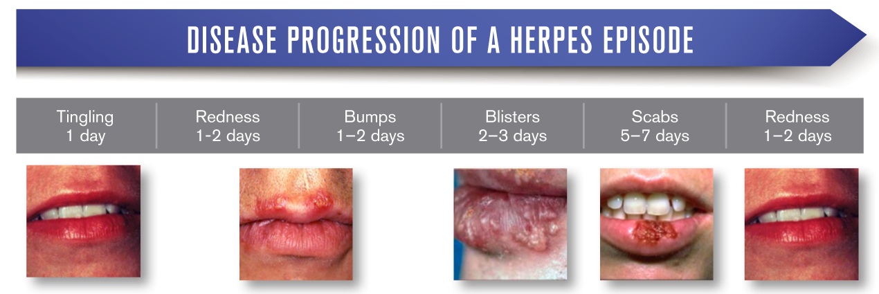 Stages Of A Cold Sore Breakout Sitavig Acyclovir 50mg Muco Adhesive Buccal Tablets